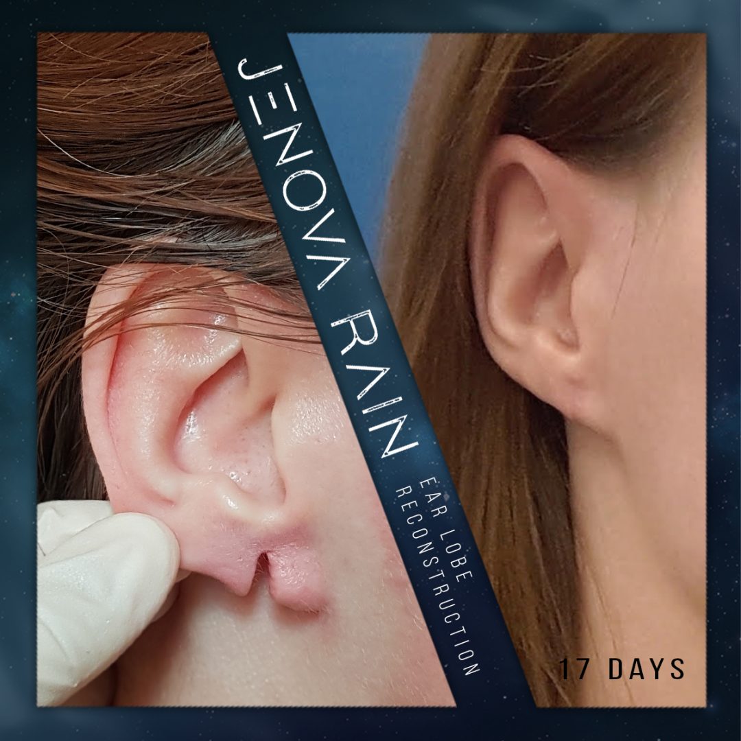 Jenova Rain » Ear Lobe Repair Before and After Photos
