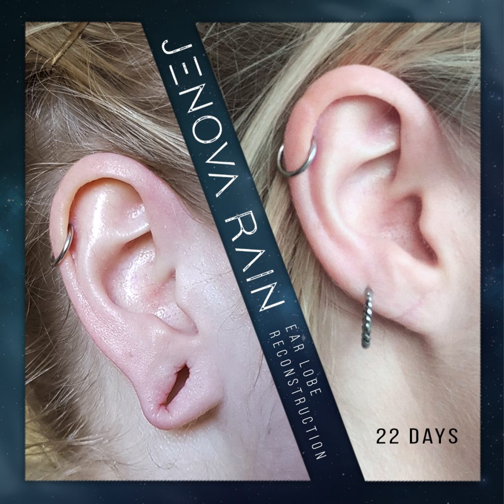 Jenova Rain » Ear Lobe Repair Before and After Photos