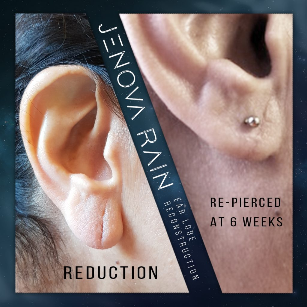 Jenova Rain » Ear Lobe Repair Before and After Photos