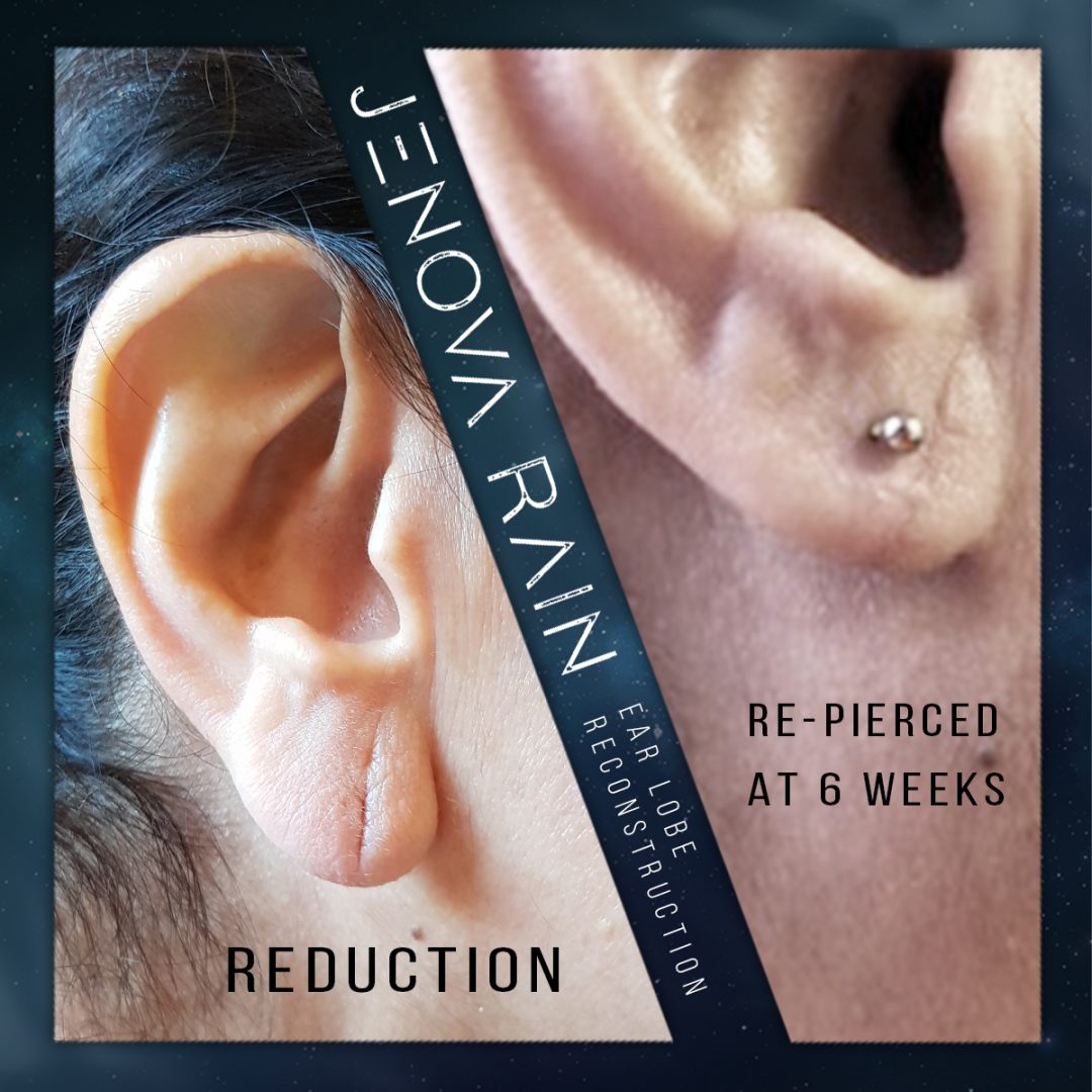Jenova Rain » Ear Lobe Repair Before and After Photos