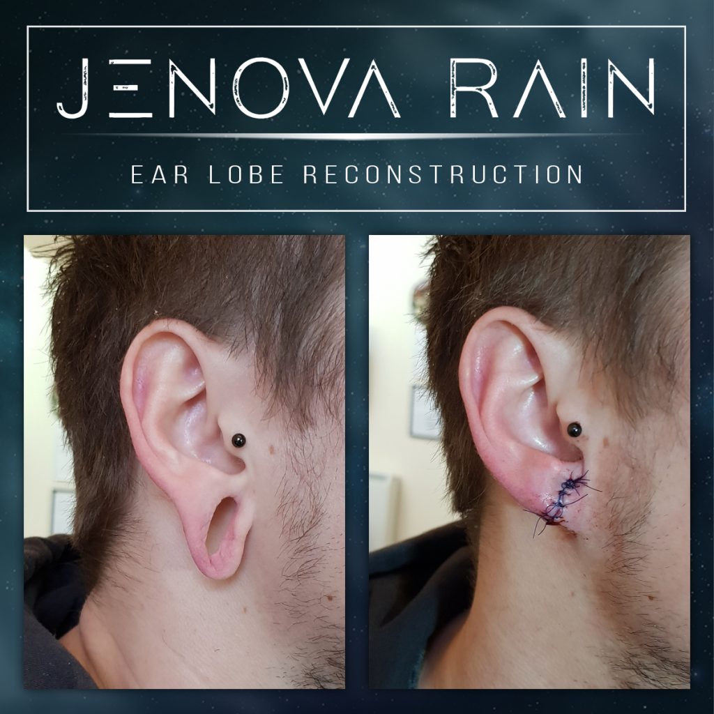 Jenova Rain » Ear Lobe Reconstruction Gallery