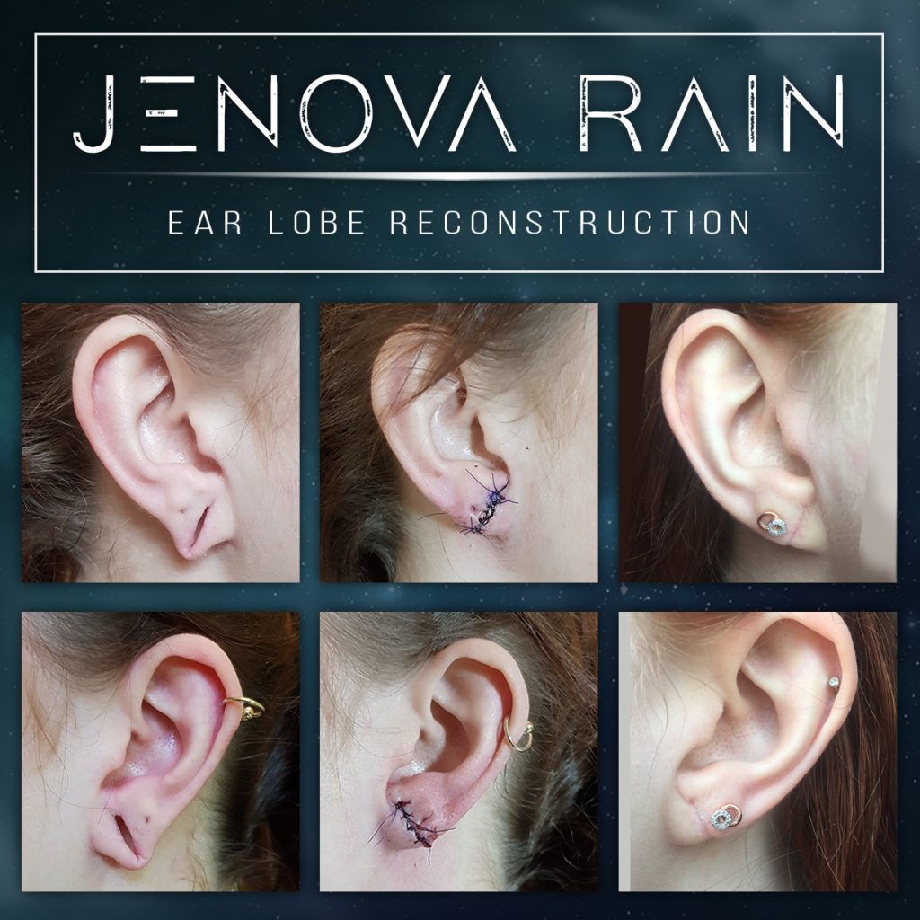 Jenova Rain » Ear Lobe Reconstruction Gallery